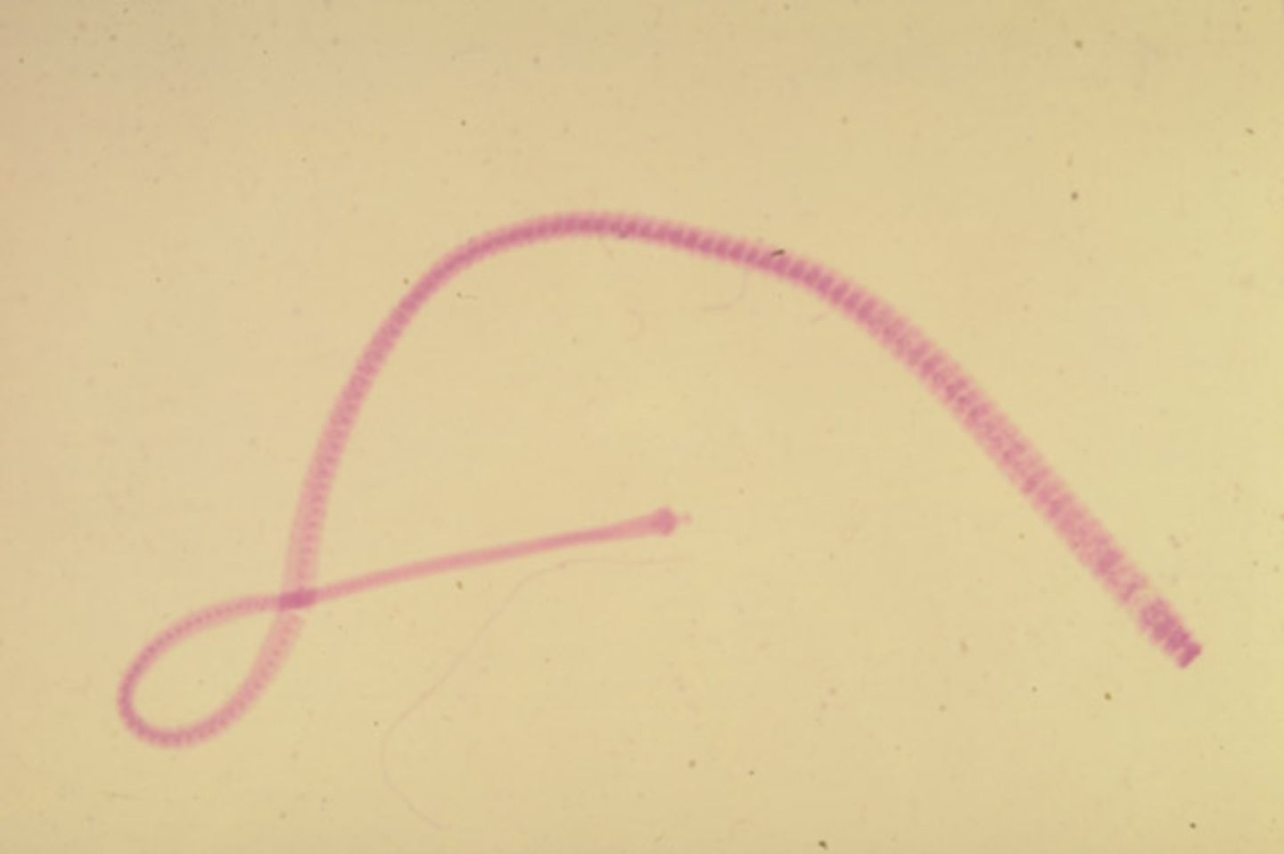 Hymenolepiasis | Parasite Diagnosis