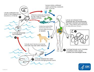 Dracunculiasis | Parasite Diagnosis