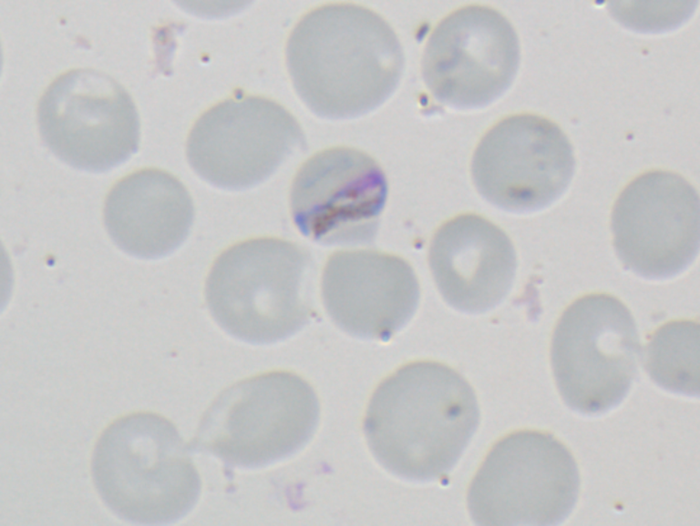Malaria quartana | Parasite Diagnosis